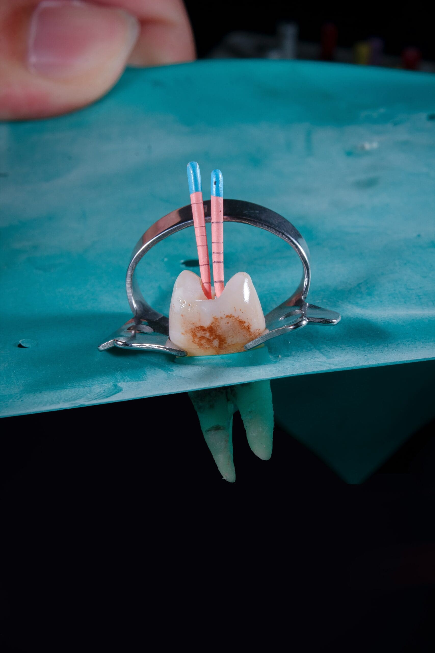 The Hidden Time Bomb in Your Mouth: Root Canal Risks & How Thermography ...